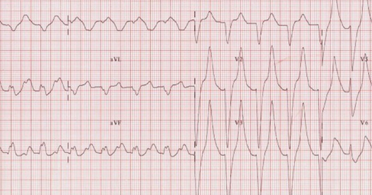 Tamponad (Kardiyak) Nedir? | Tozlu Mikrofon